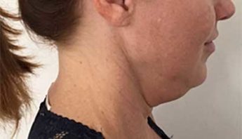 Belkyra cosmetic treatment to gradually reduce a double chin