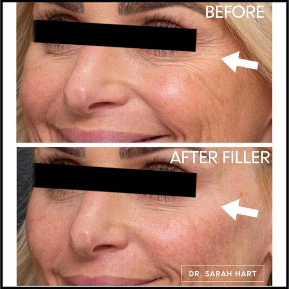 Five Botox myths you should know about to get a better result